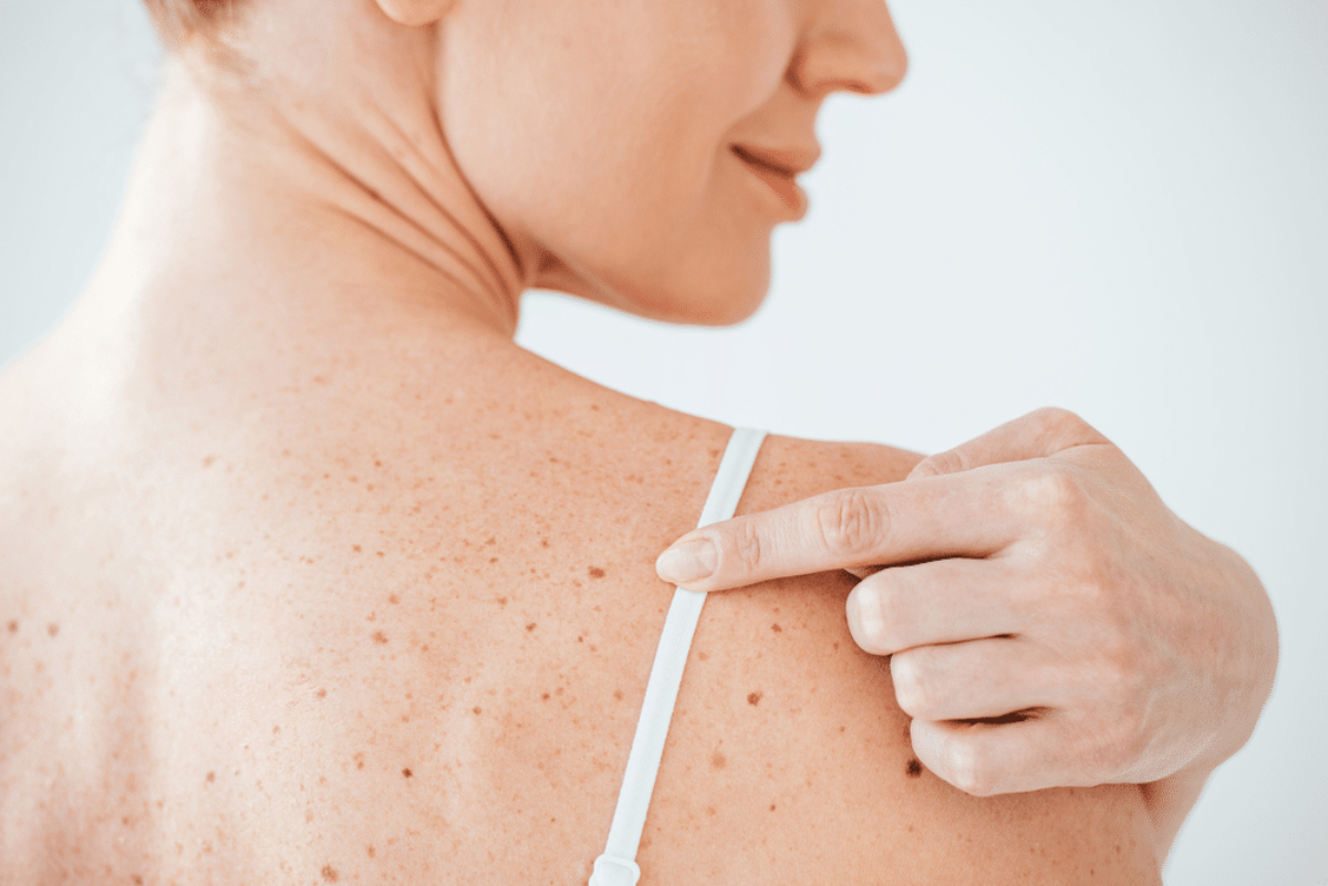 Skin Moles Removal